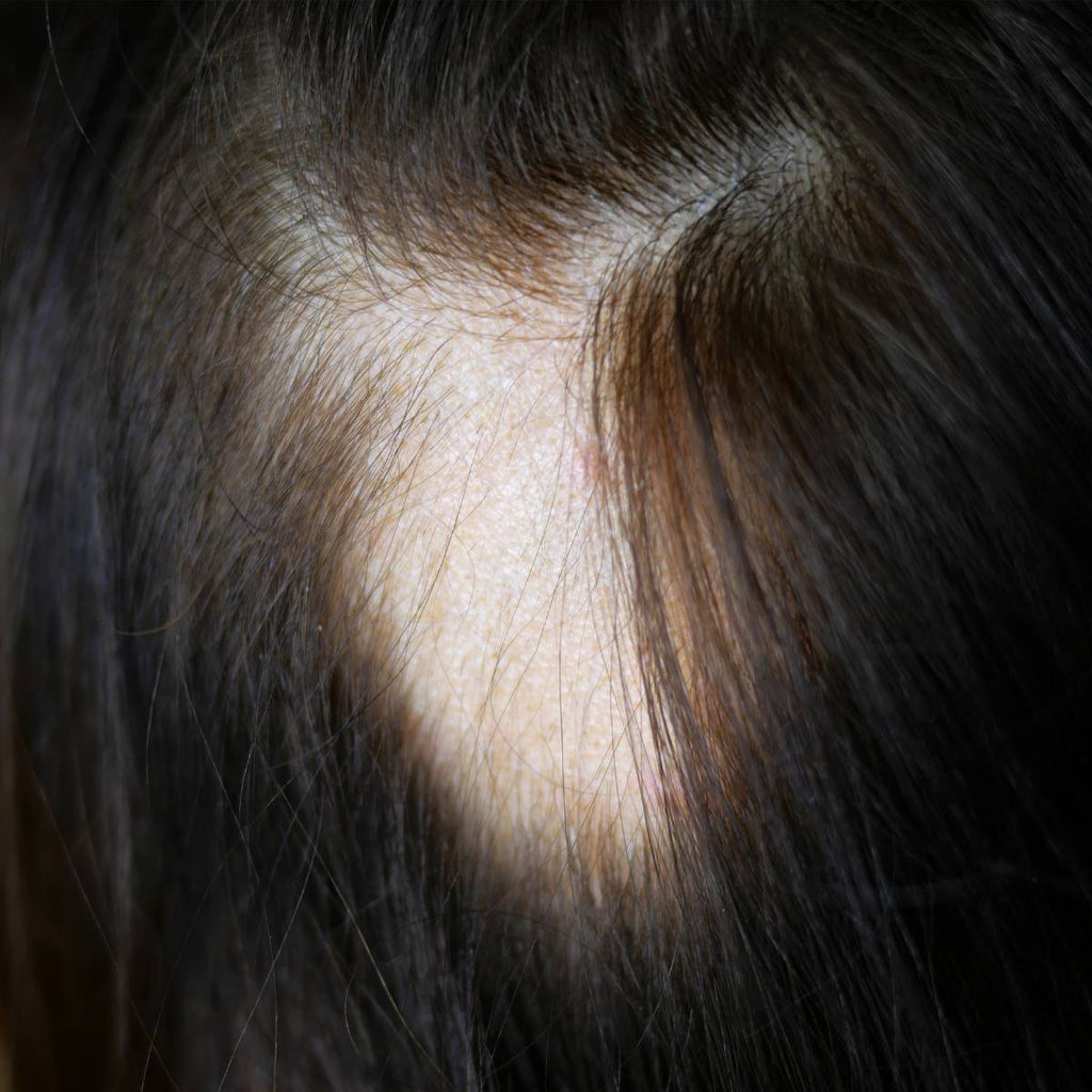 Male and Female Pattern Baldness: Understanding Androgenetic Alopecia ...