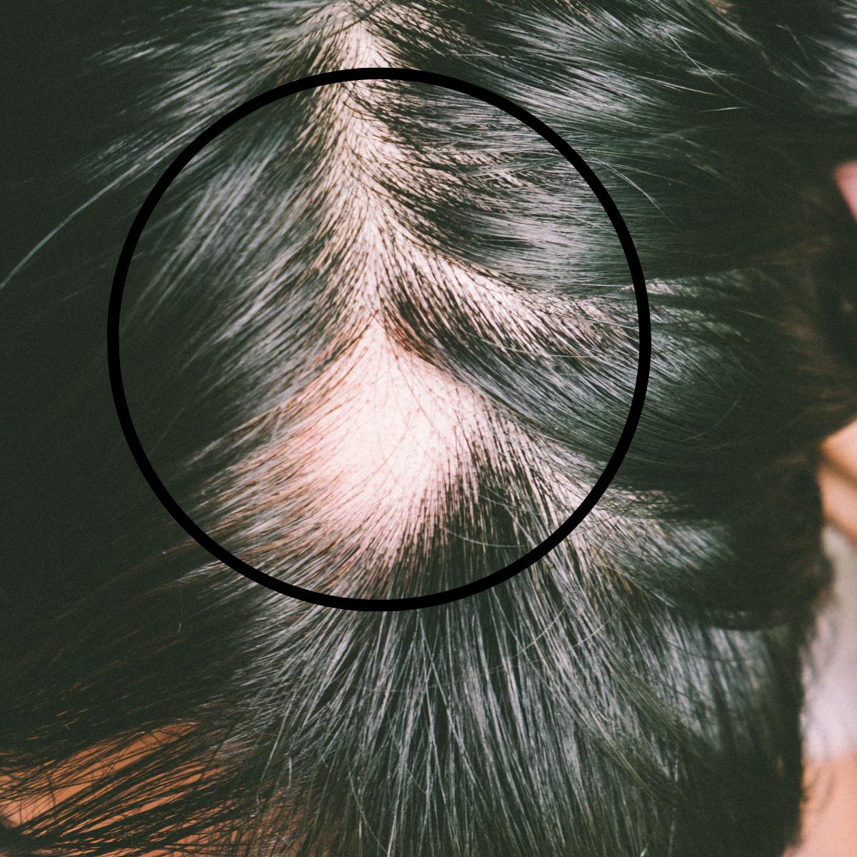 Telogen Effluvium Causes And Treatment Options Wig Medical